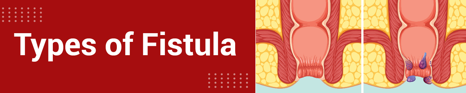 Types of Fistula: Fistula Needles & Treatment Options|Medikabazaar ...